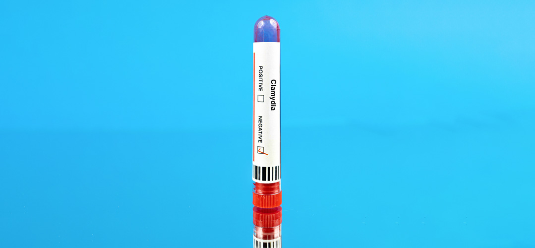 Clamydia (Chlamidia Sau Clamidia) – Marie Stopes International